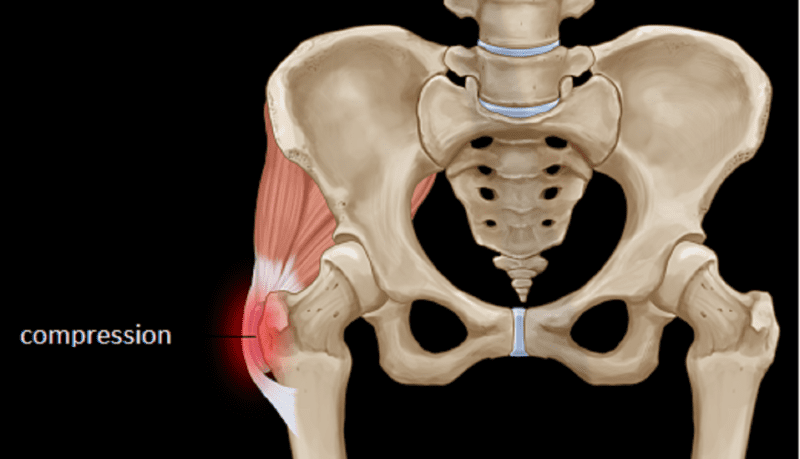 Hip Pain - Gluteal Tendinopathy - Head2Toe Physio
